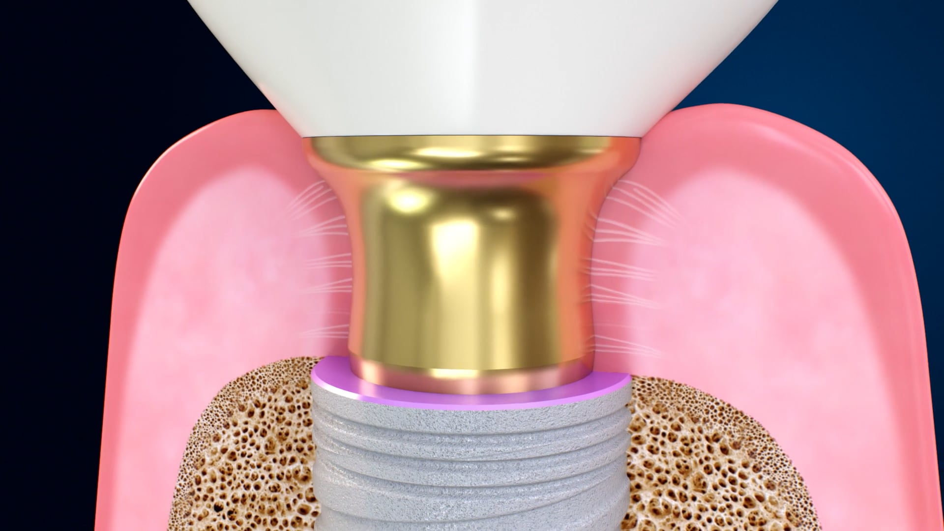 MIS C1: Conical Connection Dental Implant on Vimeo