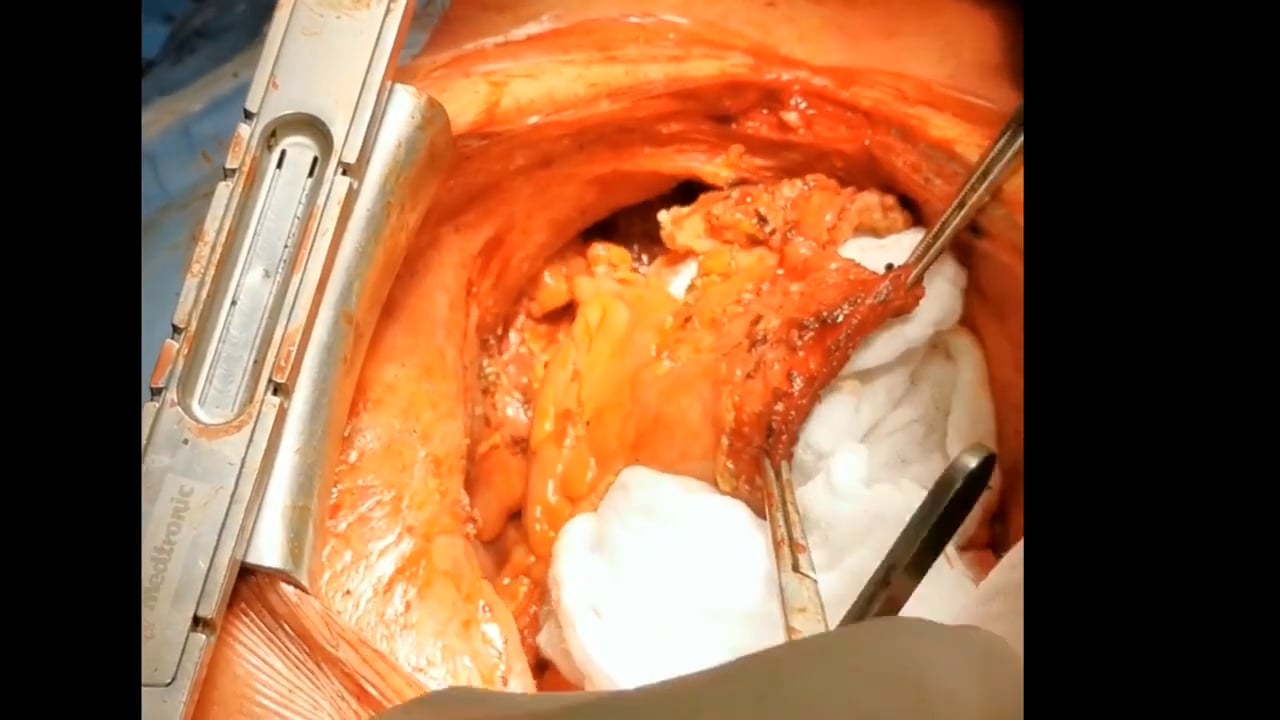Pericardiectomy for constrictive pericarditis | MMCTS