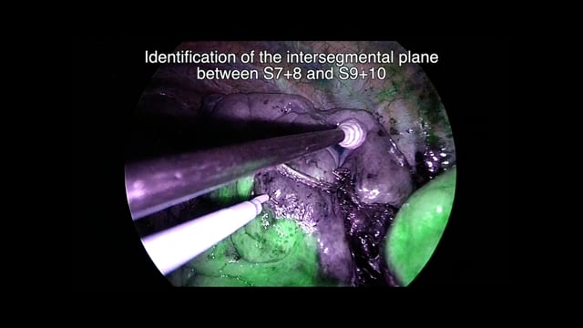 Uniportal thoracoscopic lateral and posterior (S9+10) segmentectomy ...