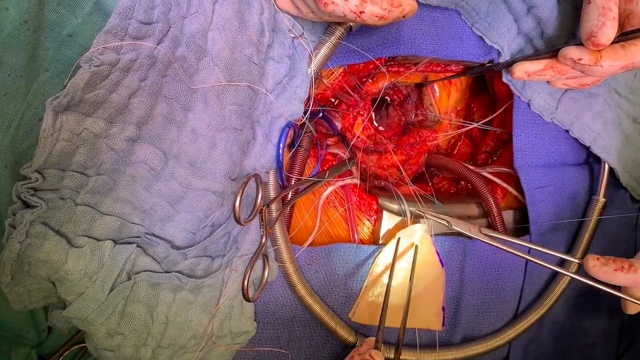 The Konno-Rastan procedure | MMCTS
