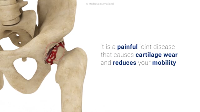 Anterior THA Using AMIS- Patient Preparation and Surgical Technique ...