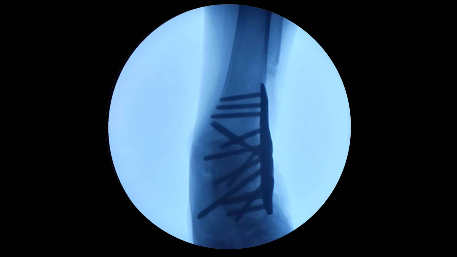Tibiotalocalcaneal (TTC) Arthrodesis Lab with Dan Robinson, DPM, FACFAS ...