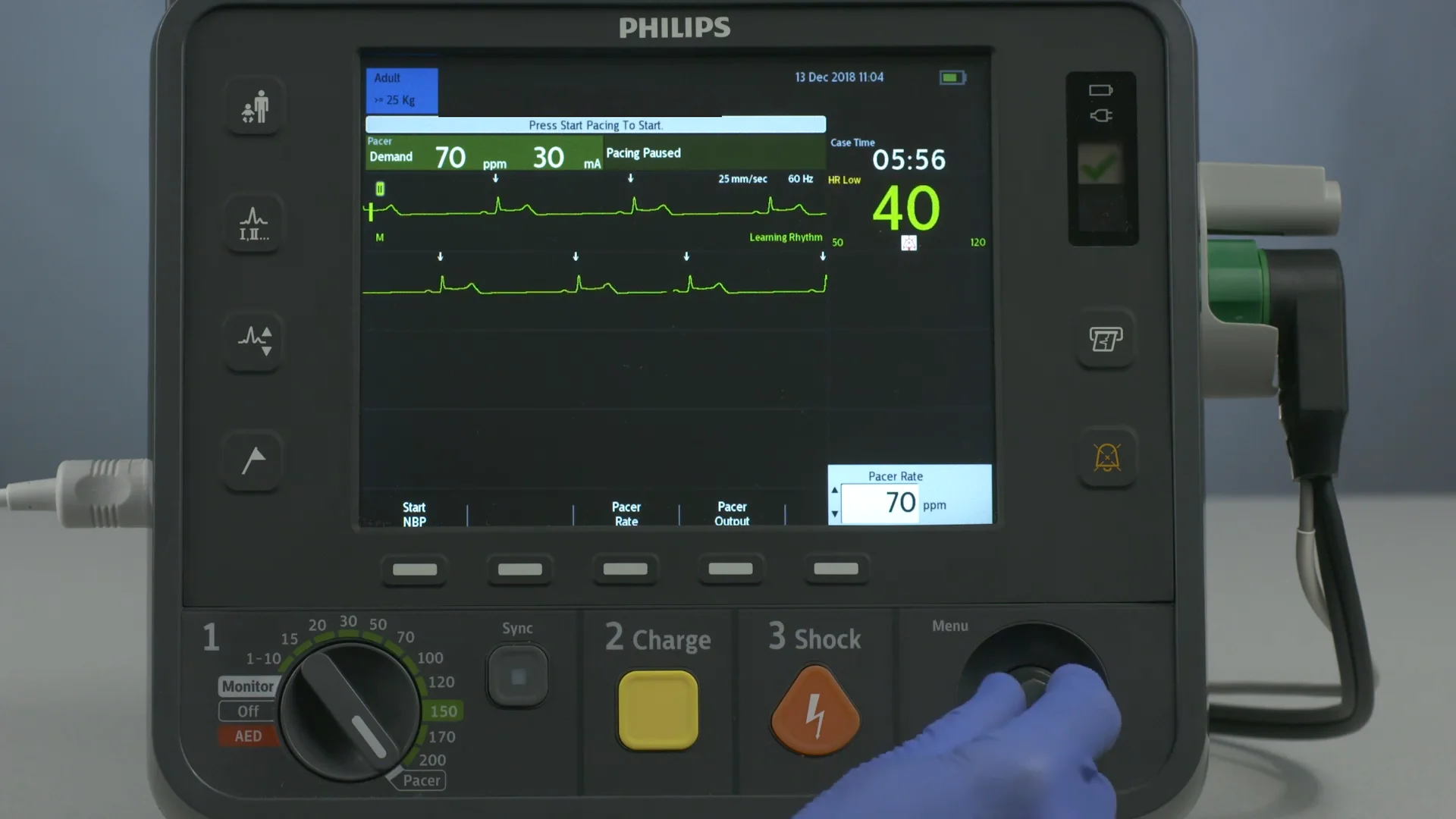 6 - NonInvasive Transcutaneous Pacing with the HeartStart Intrepid ...