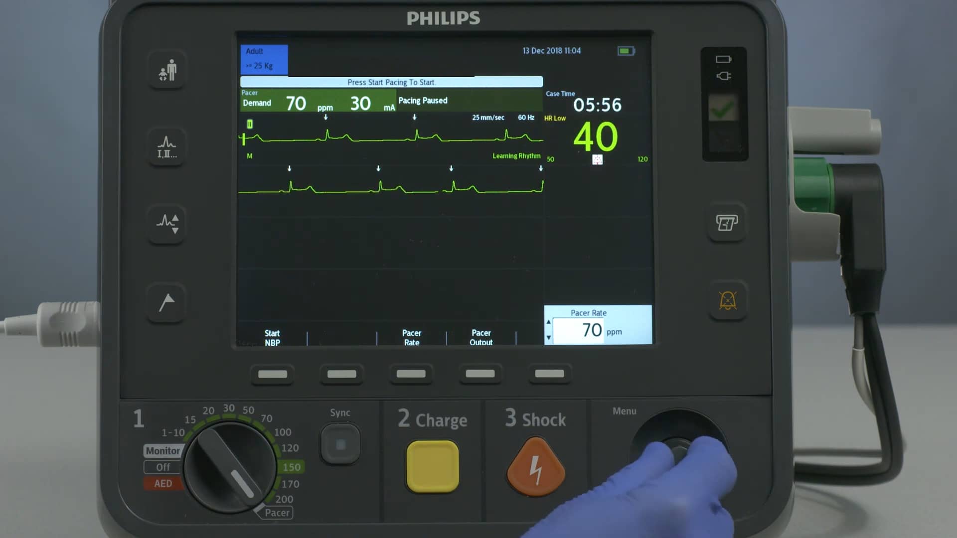 6 - NonInvasive Transcutaneous Pacing with the HeartStart Intrepid ...
