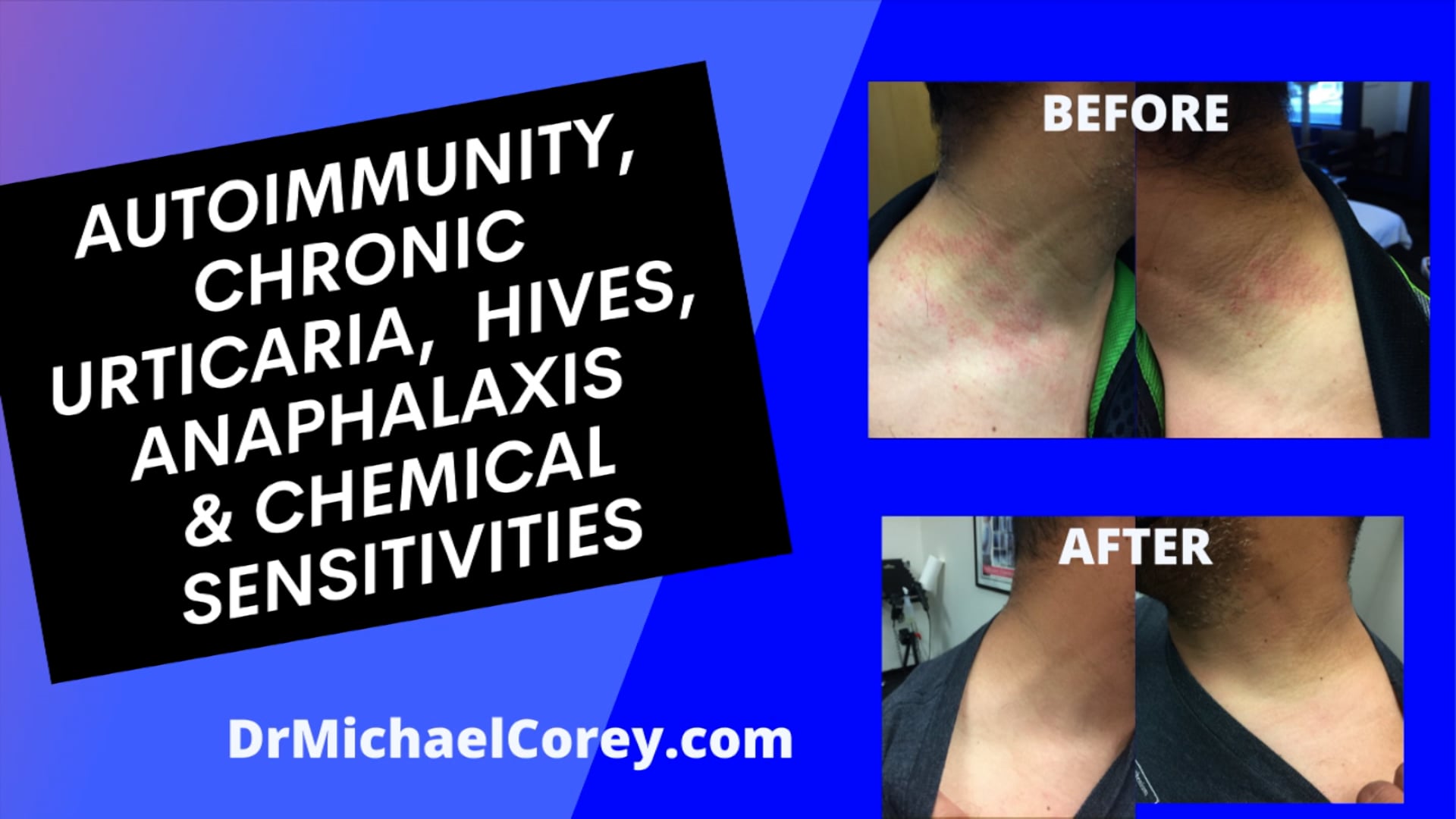 Autoimmunity, Chronic Urticaria, Hives, Anaphylaxis & Chemical ...