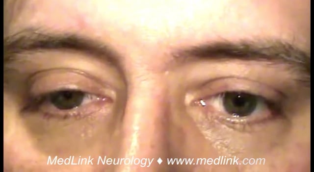 Horner syndrome | MedLink Neurology
