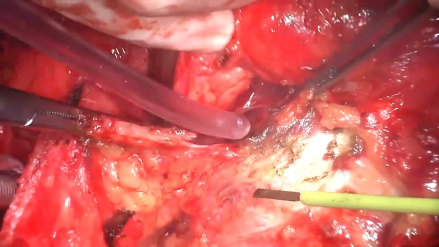Radical pericardiectomy for pericardial diseases | MMCTS