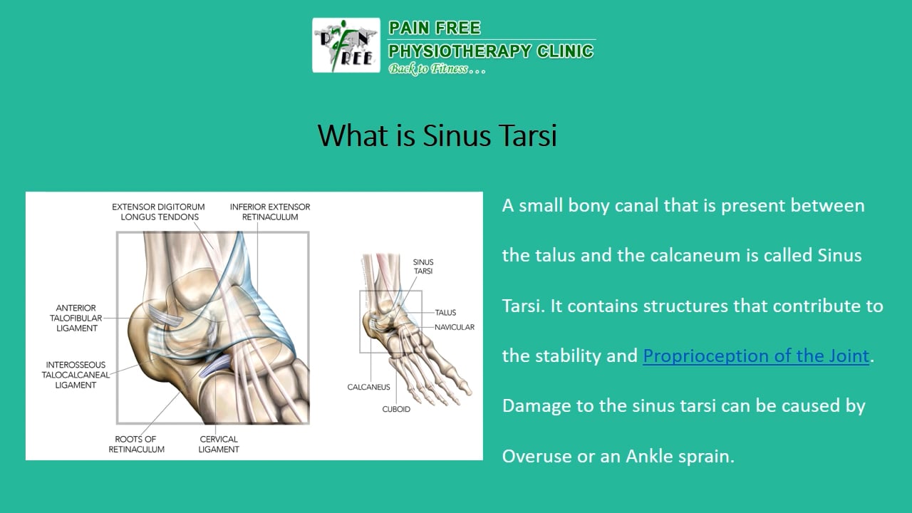 Sinus Tarsi Syndrome - Pain Free on Vimeo