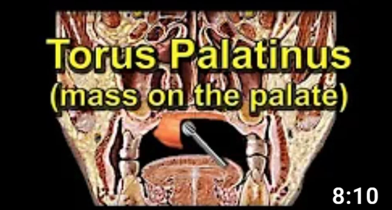 How To Remove A Tumor/ Lump On The Palate (Torus Palatinus)
