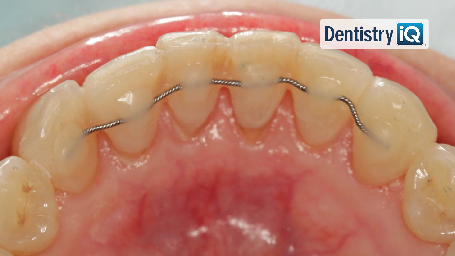 Best Practices for Best Practices: 6 steps to fixed ortho retention ...