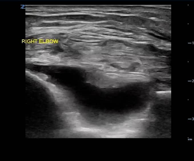 Arthrocentesis Video 5 - US demonstrating displacement of posterior fat ...