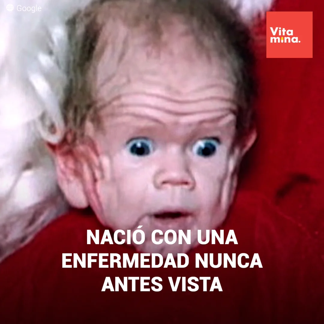 Tomm Tennent El bebé que nació con tanta piel como para cubrir un niño ...