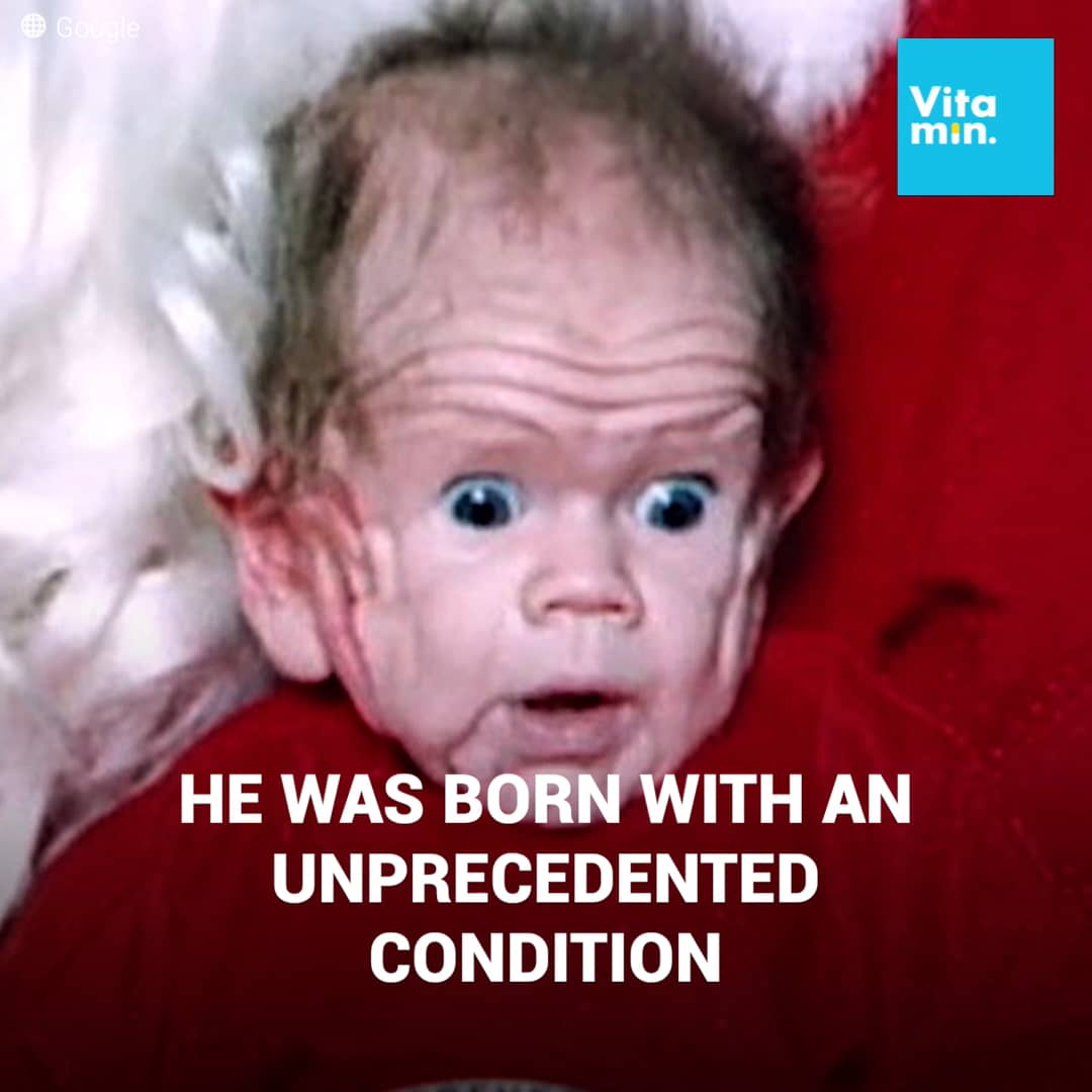 ING Tomm Tennent El bebé que nació con tanta piel como para cubrir un ...