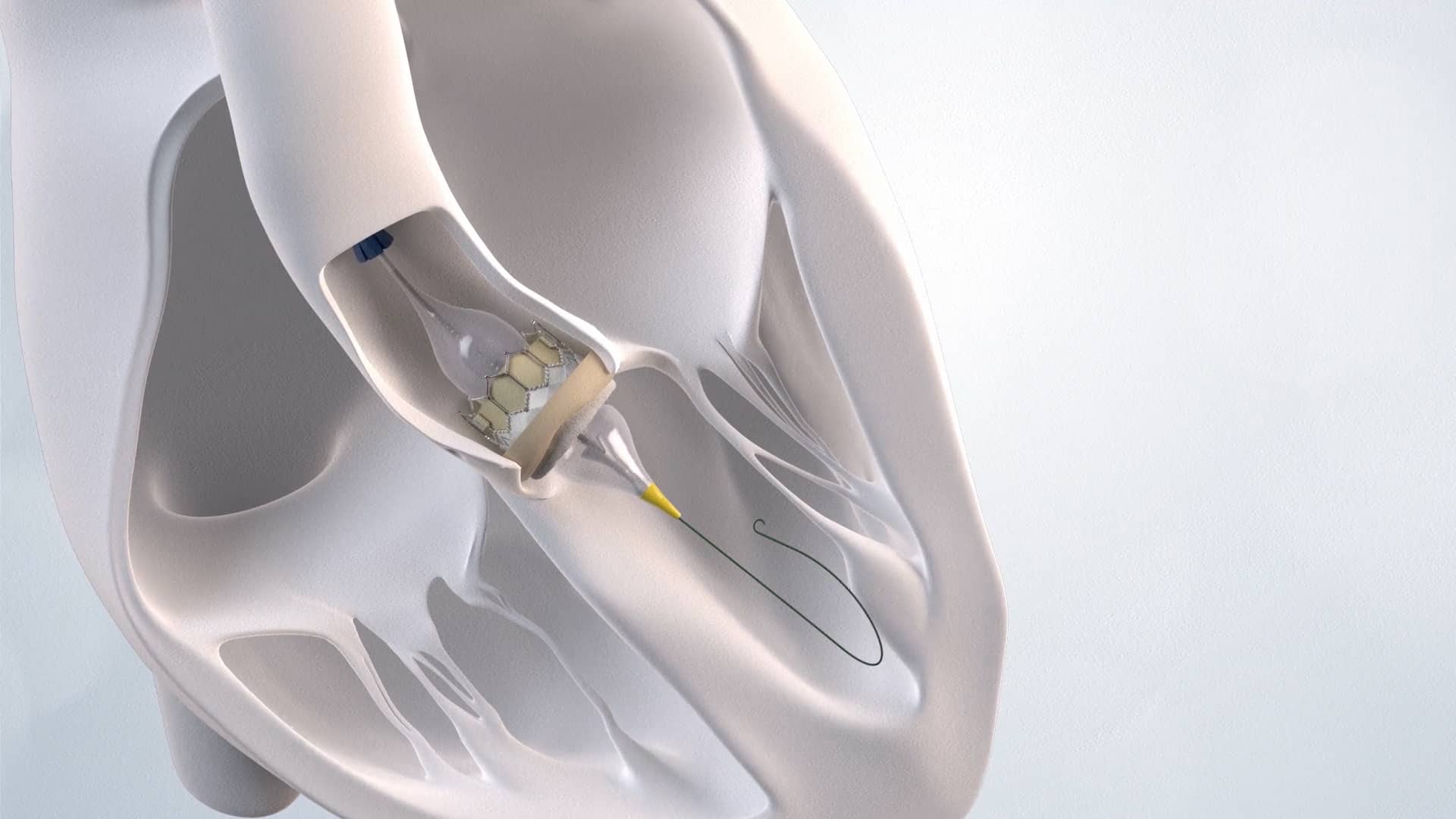 TAVR procedure animation on Vimeo