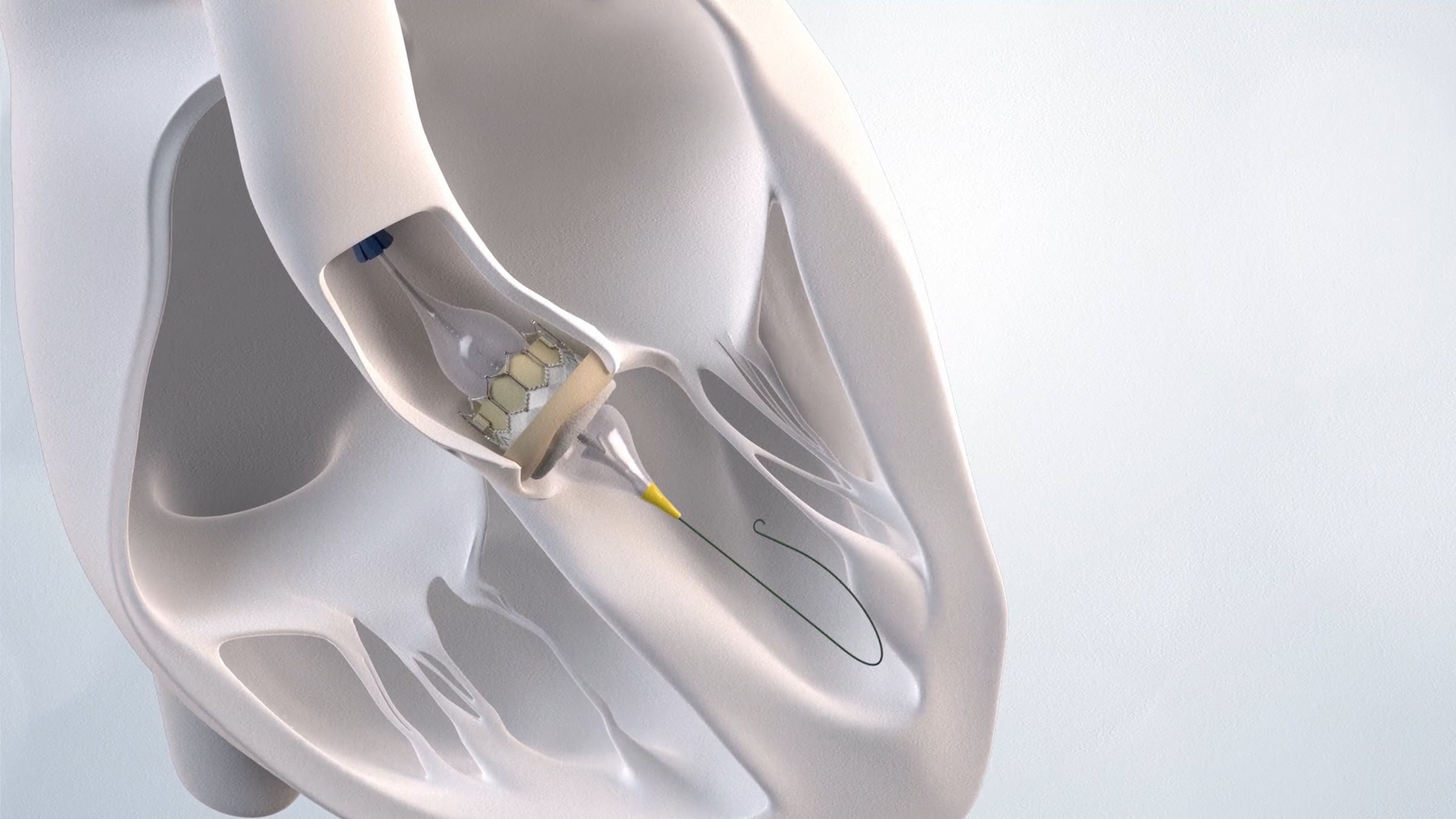 TAVR procedure animation