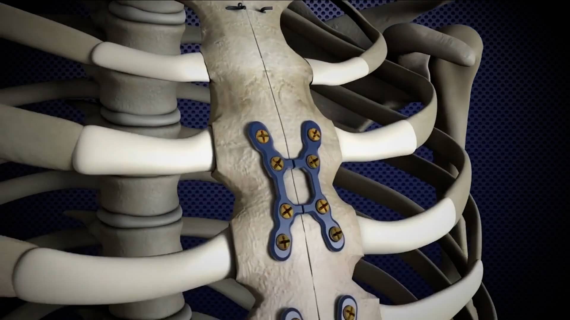 SternaLock Blu Primary Sternal Closure System | Zimmer Biomet on Vimeo