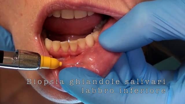 BIOPSIA GHIANDOLE SALIVARI on Vimeo