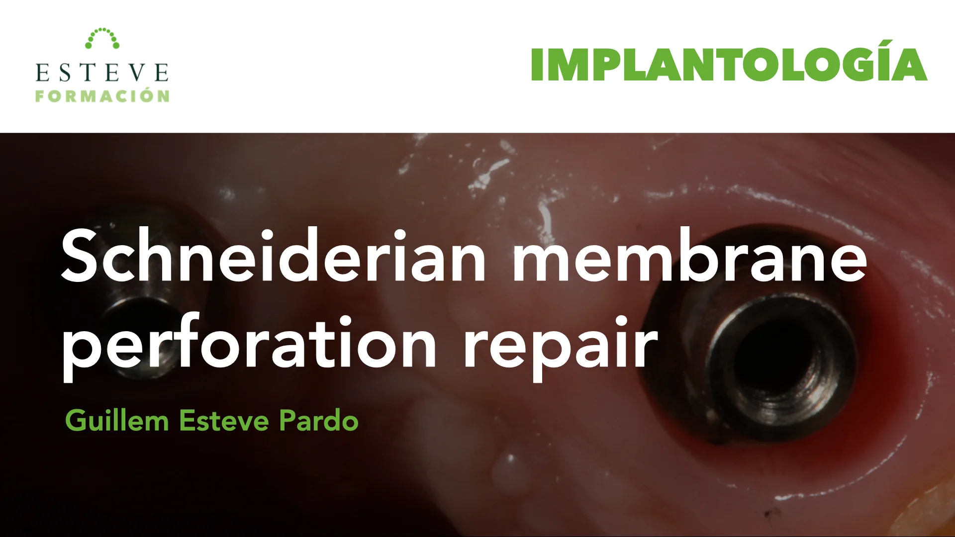 Schneiderian Membrane perforation repair.m4v on Vimeo