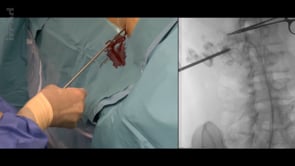 Large renal stone treated with percutaneous nephrolithotomy (PCNL): a ...