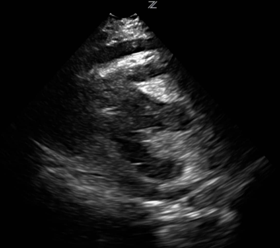 Pericardiocentesis Video 5 - Pericardiocentesis, visualizing the needle ...