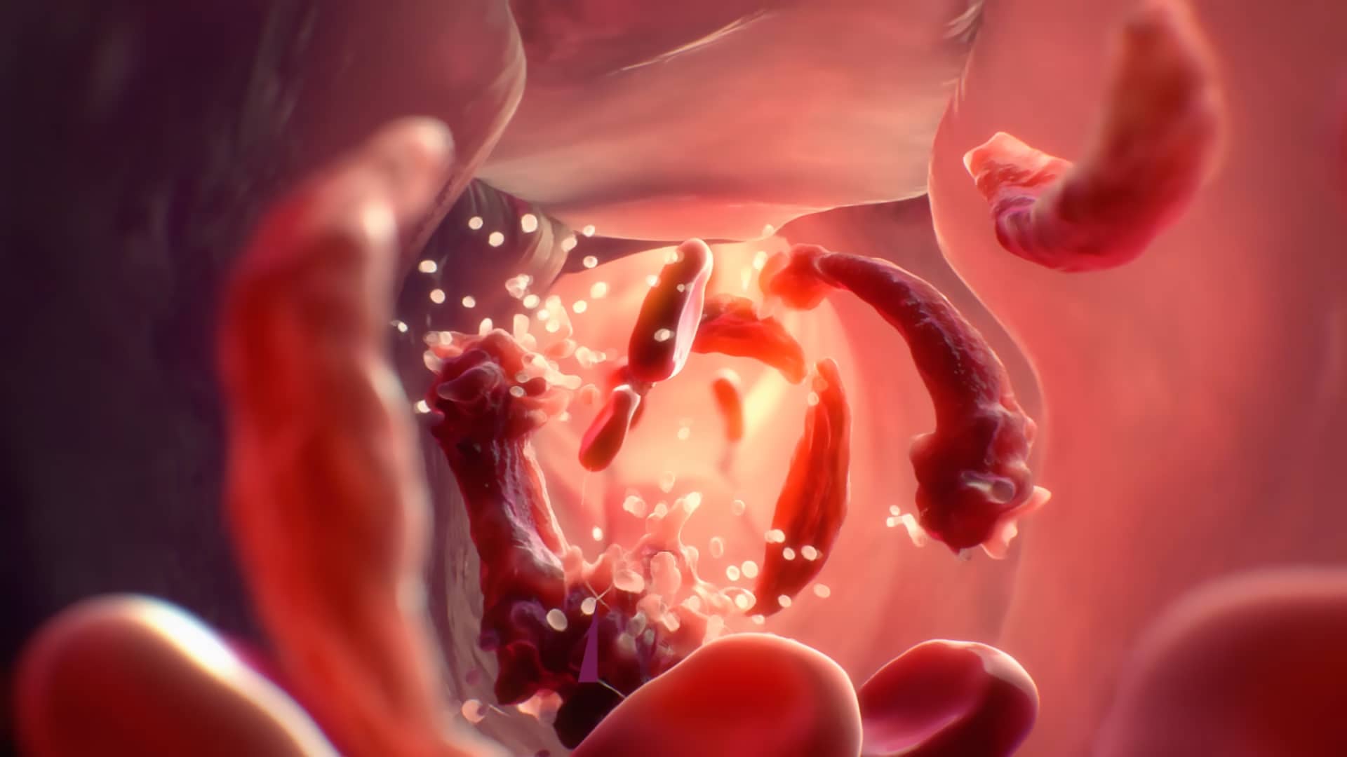 HbS polymerization & sickle cell disease on Vimeo
