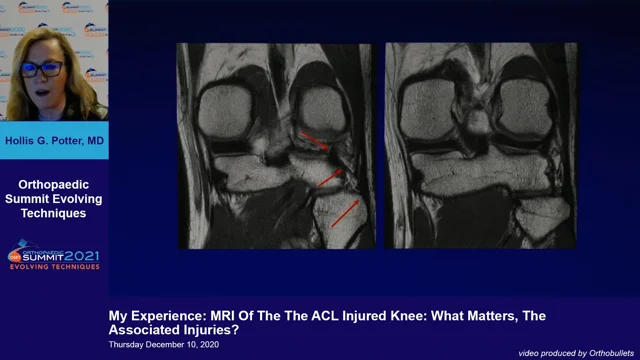 Mri Knee Acl