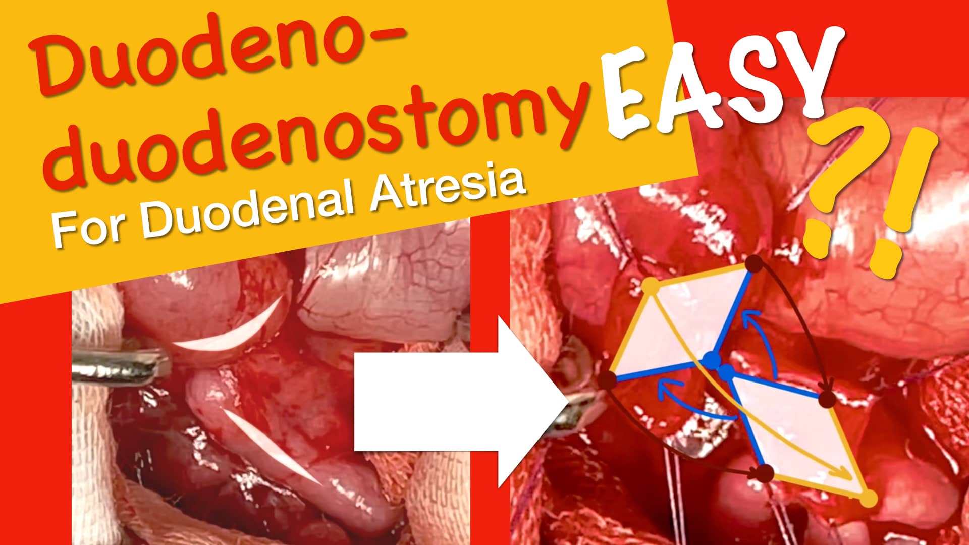Duodeno-duodenostomy for Duodenal Atresia on Vimeo