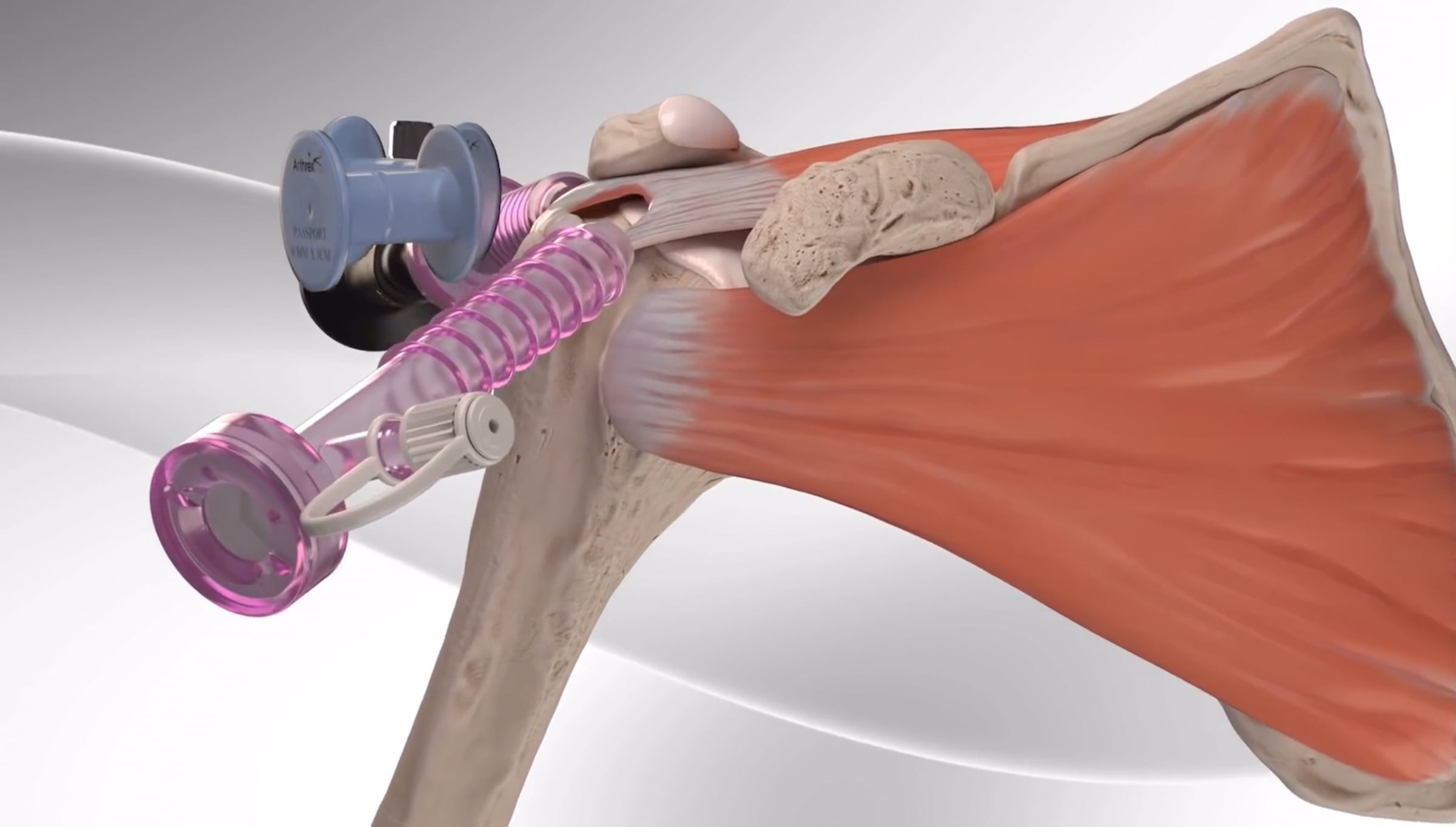 Rotator Cuff Repair