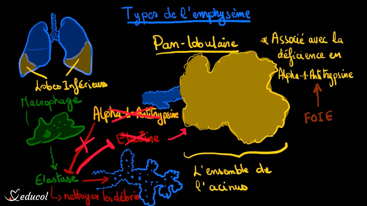 Emphysème centro lobulaire, emphysème panlobulaire, emphysème ...