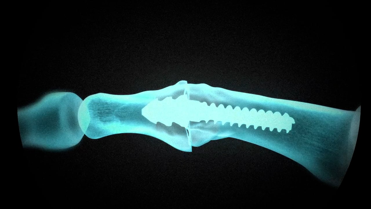 ExtremiFuse Hammertoe Fixation System Surgical Technique Overview on Vimeo