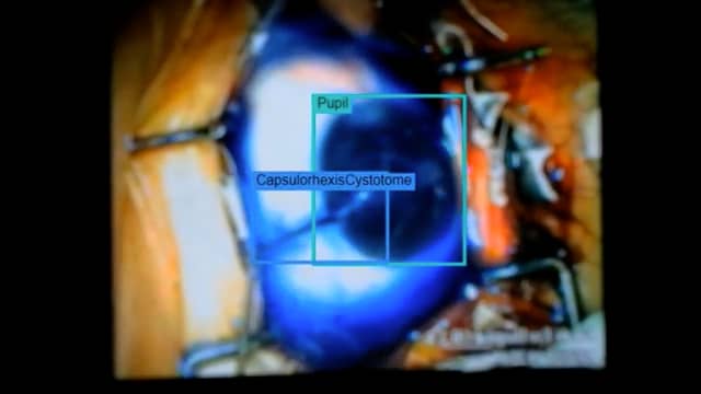 Realtime Performance in Tracking the Capsulorhexis Cystotome and Pupil ...