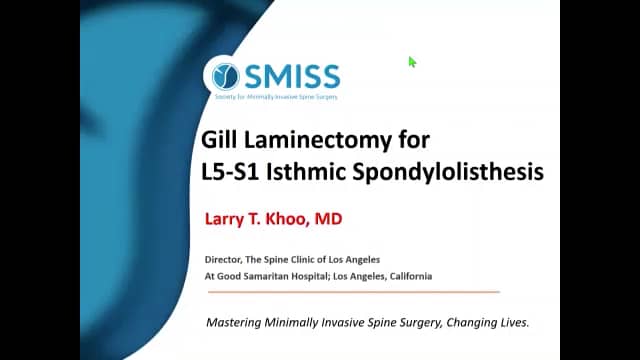 Gill Laminectomy for L5-S1 Isthmic Spondylolisthesis on Vimeo