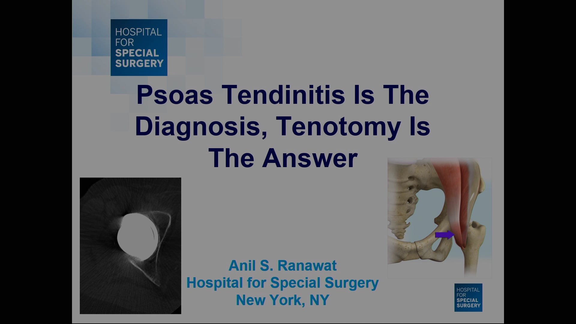 18--Pro- Psoas Tendinitis Is The Diagnosis, Tenotomy Is The Answer Anil ...