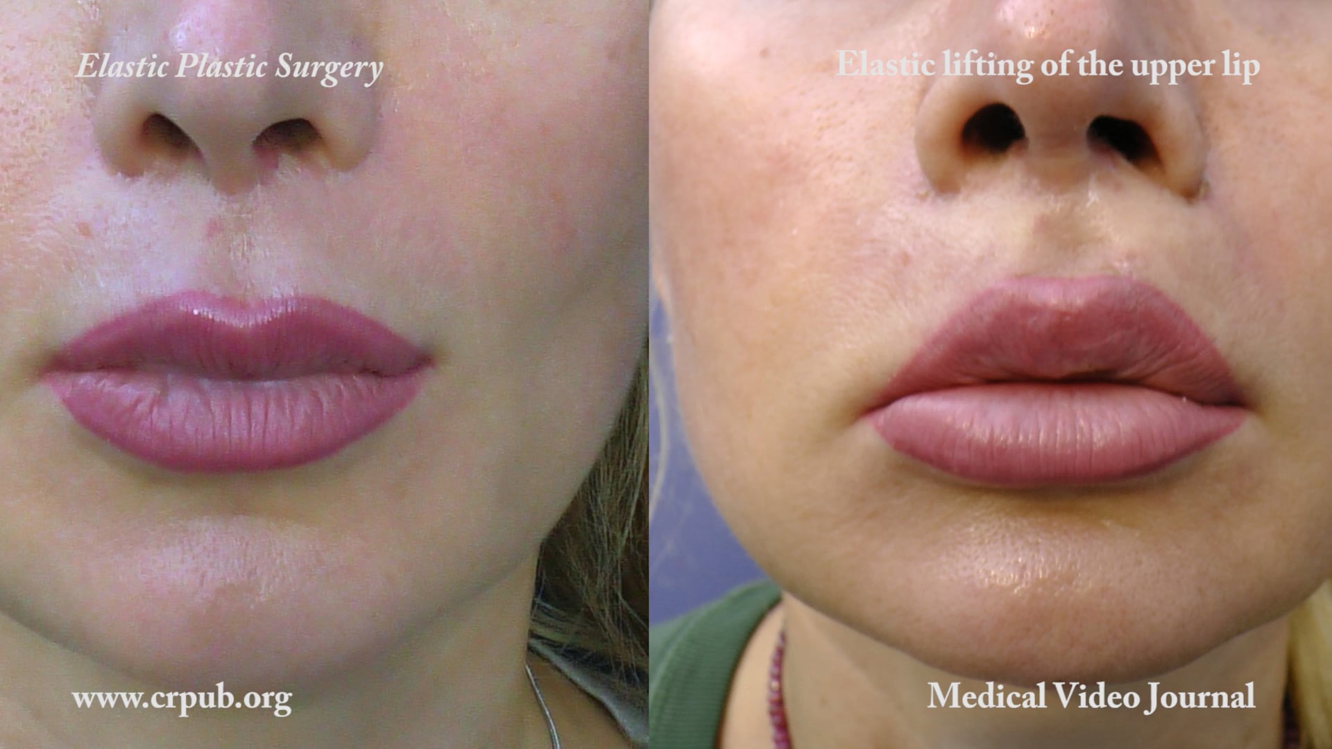 47. Elastic Lifting of the Upper Lip with three threads TRAILER on Vimeo