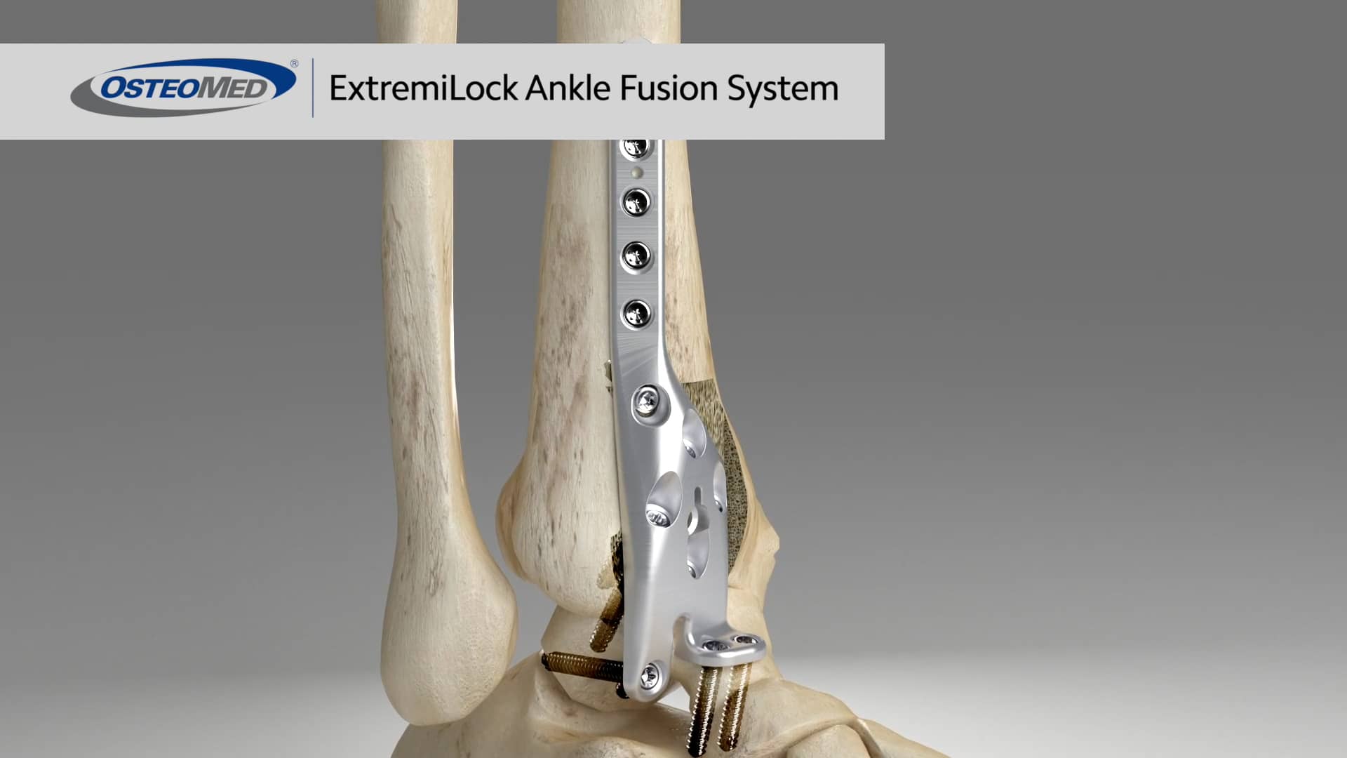 OsteoMed ExtremiLock Ankle Fusion Plates System Overview on Vimeo