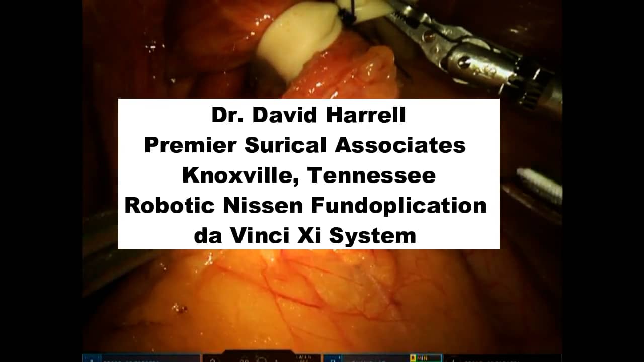 Dr. David Harrell Robotic Nissen Fundoplication--Knoxville, TN ...
