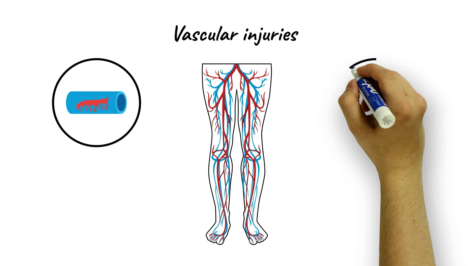 Vascular injuries - London Major Trauma System on Vimeo