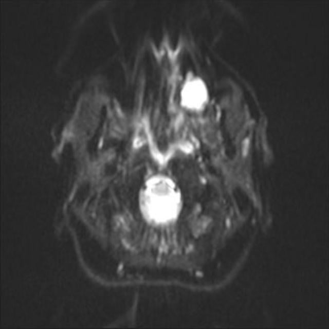 MRI of my Brain AX DWI on Vimeo