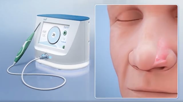 Non-Invasive Nasal Remodeling | Breathe Better | VivAer®