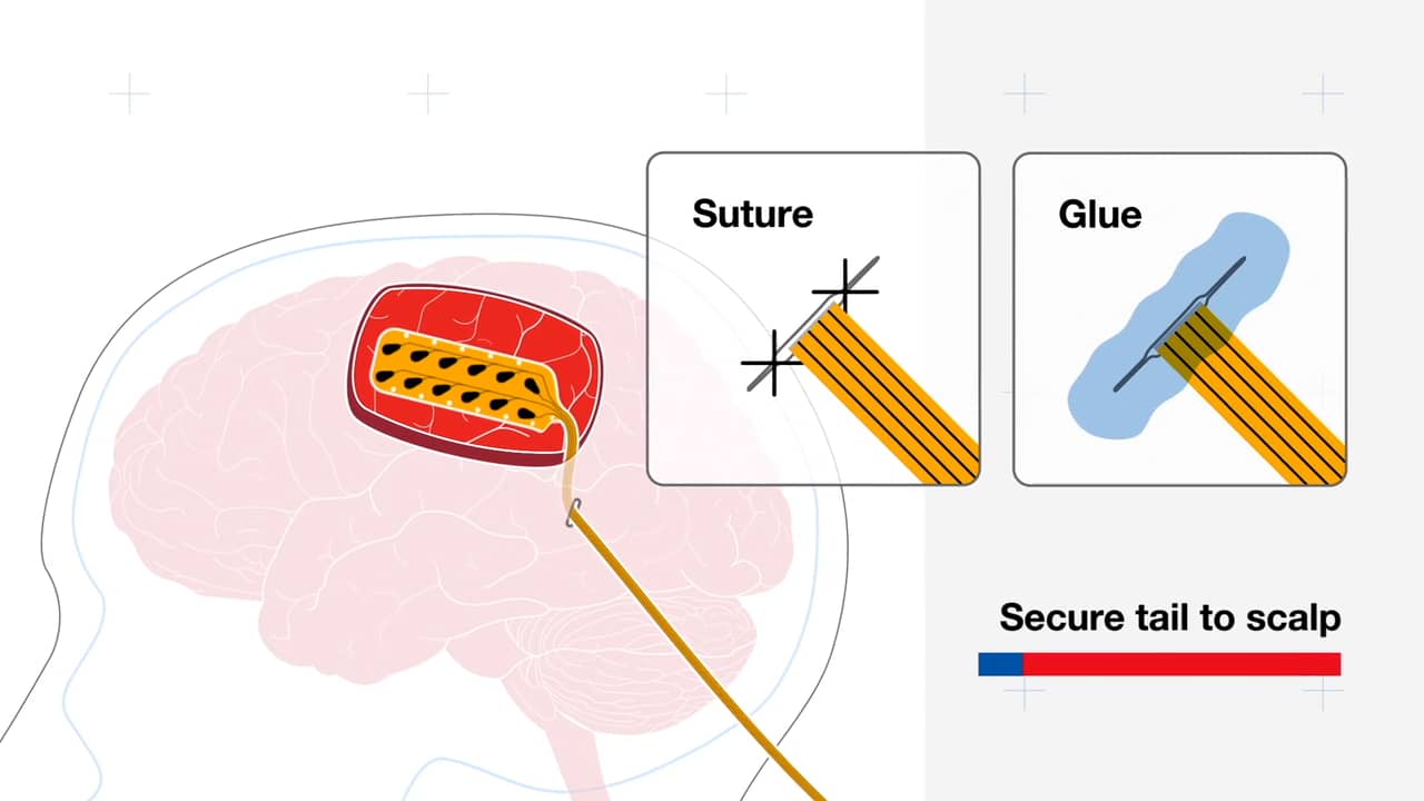 NeuroOne - Evo™ Cortical Electrode on Vimeo