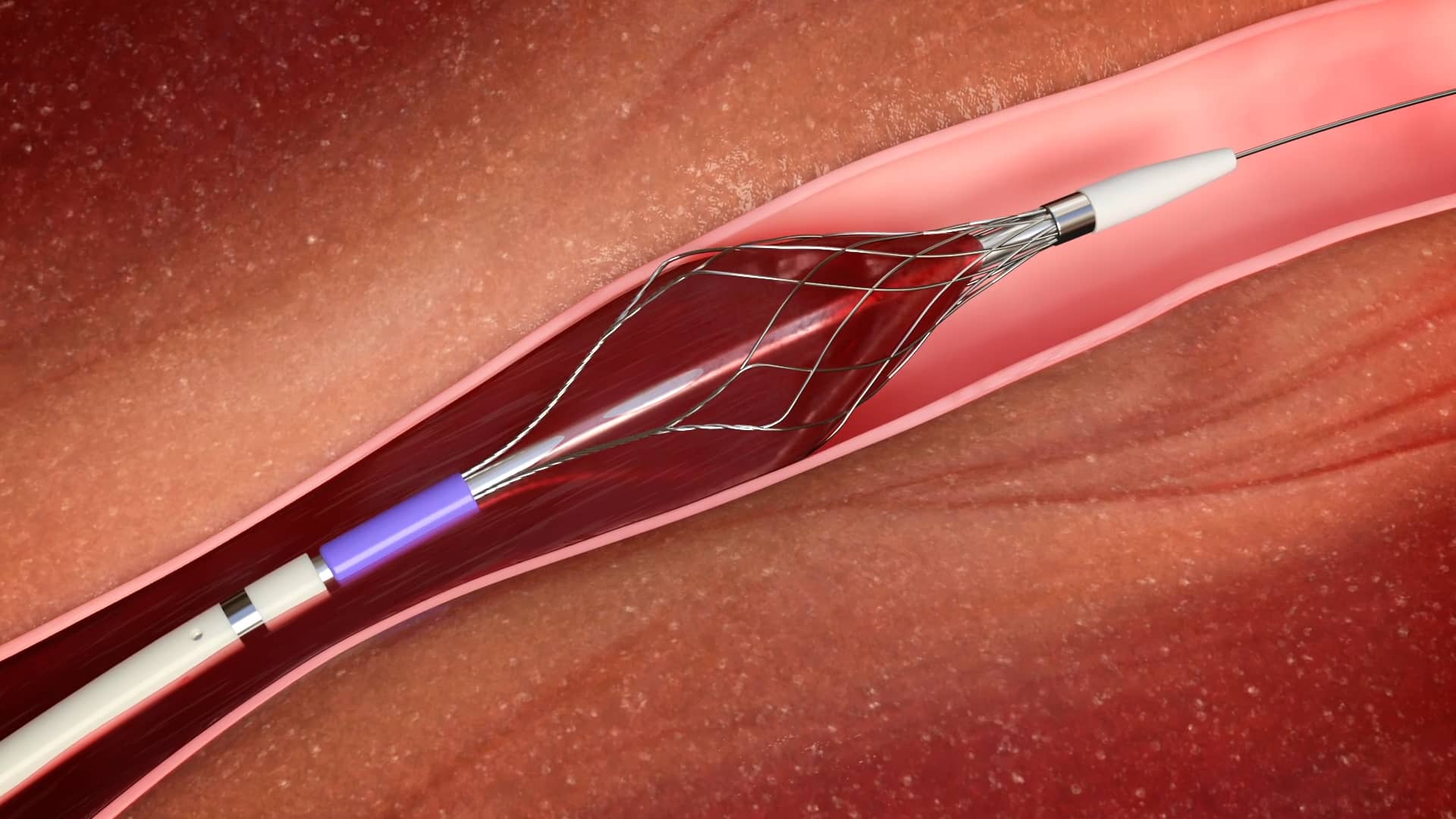 Pounce™ Venous Thrombectomy System on Vimeo