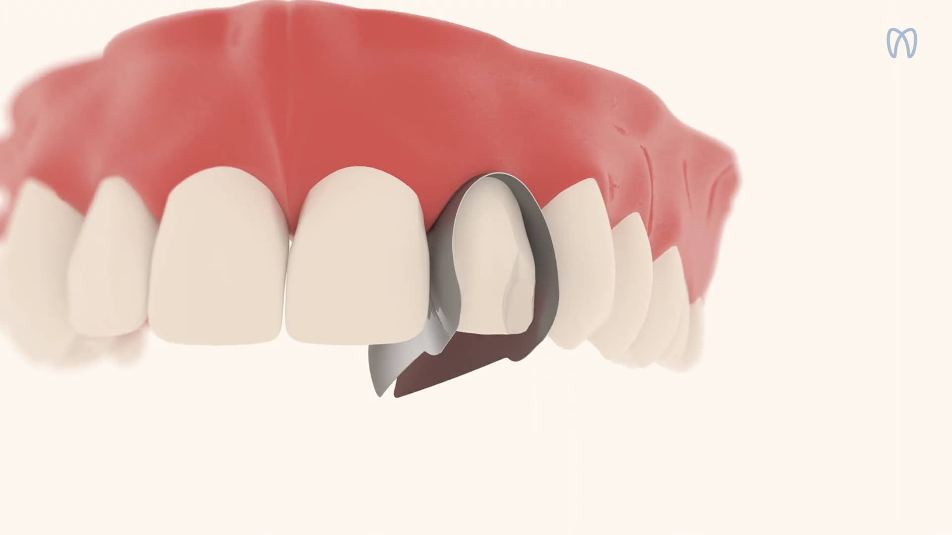 Unica anterior Frontzahnmatrizensystem - Polydentia on Vimeo