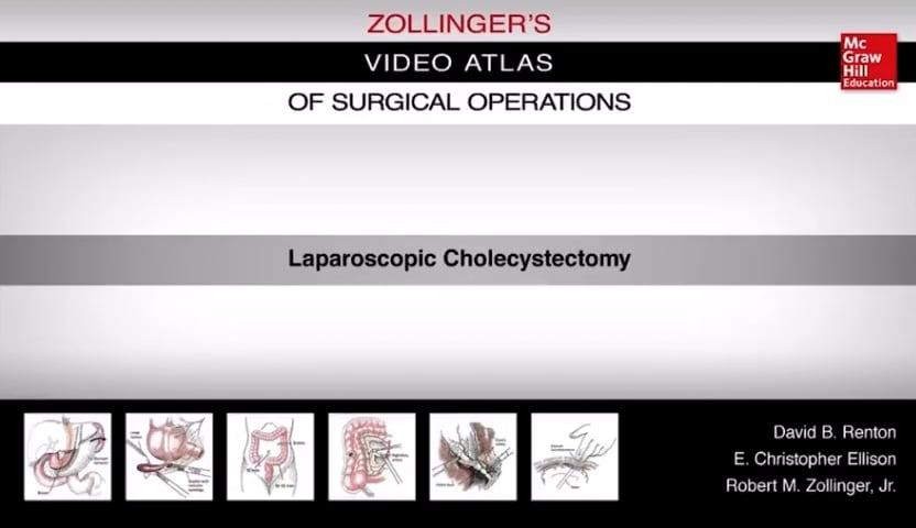 colecistectomie laparoscopic on Vimeo