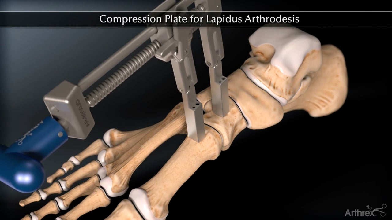 Compression Plate for Lapidus Arthrodesis.mp4 on Vimeo