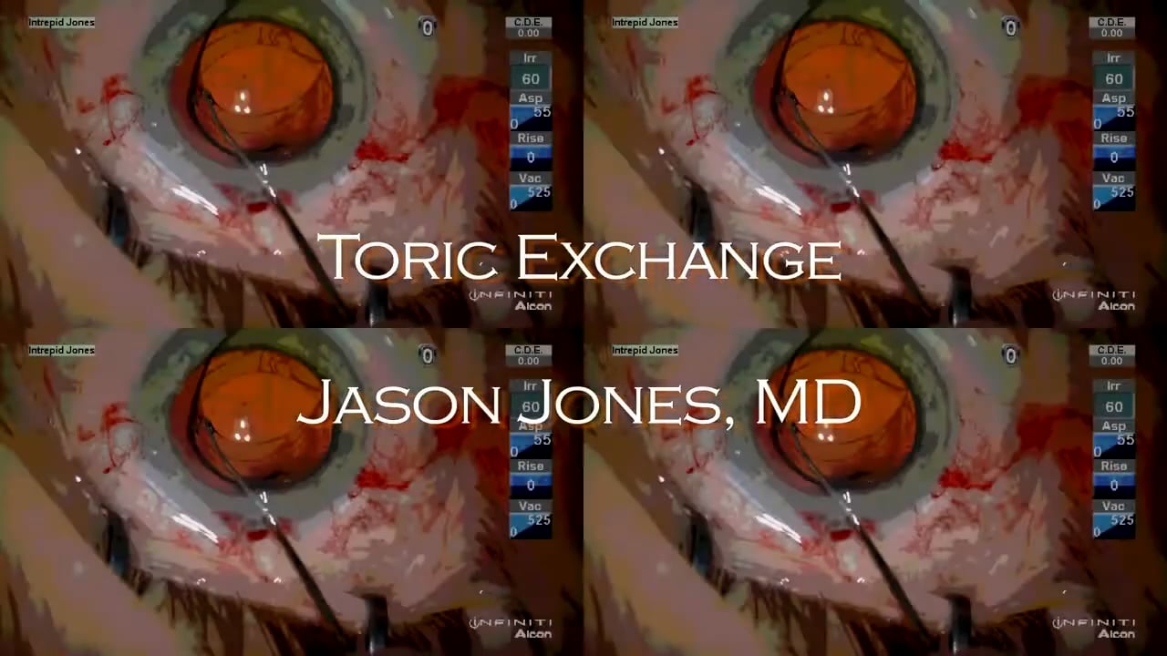 Packer Chang IOL cutter with MicroHolder Jason Jones