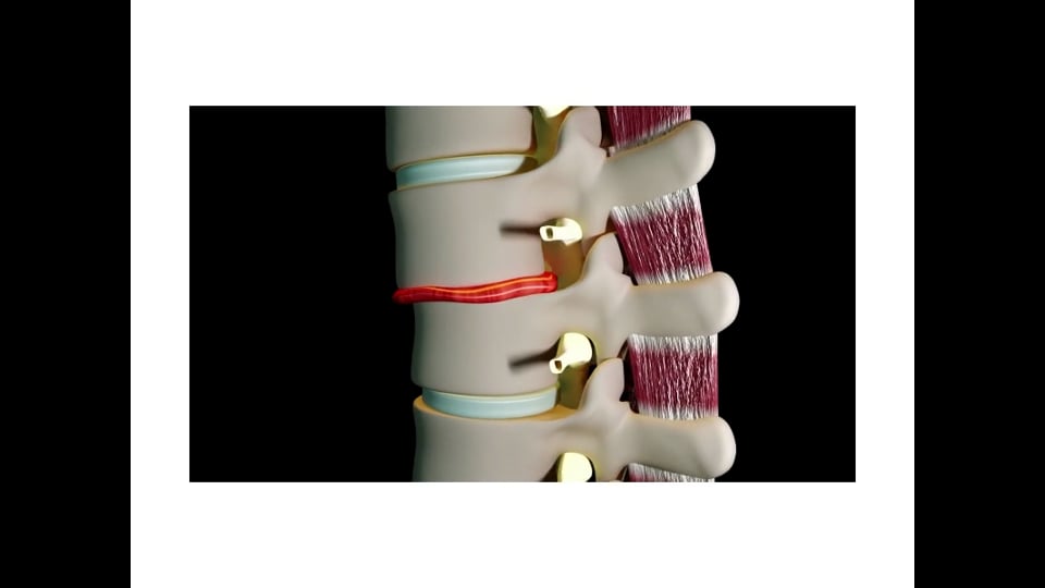 SPINE IMPLANTS