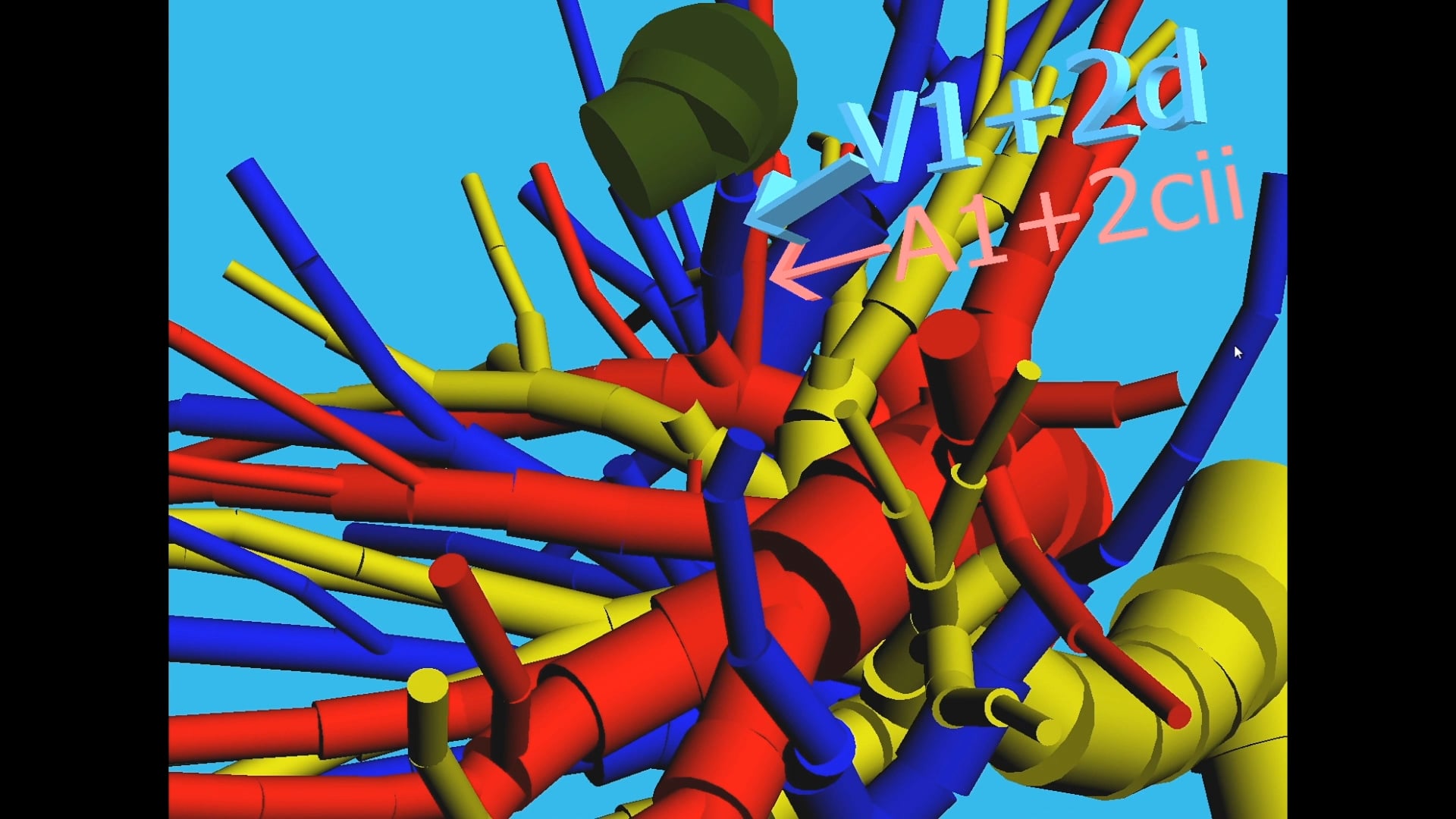 Uniportal VATS combined subsegmentectomy of the left S1+2c+S3a guided ...