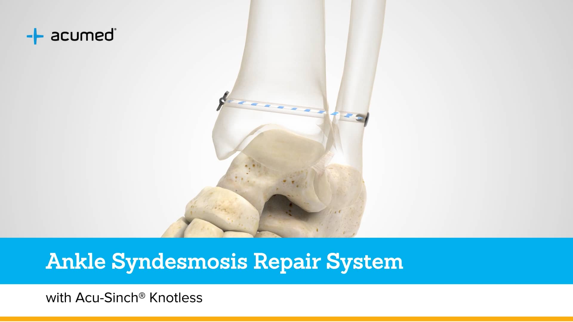 Ankle Syndesmosis Repair System with Acu-Sinch® Knotless Overview on Vimeo