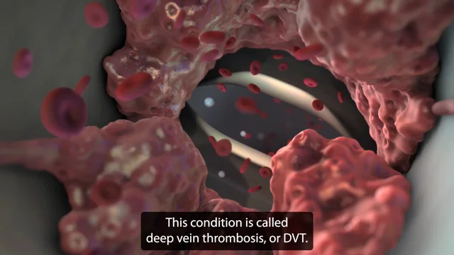 Venous Thromboembolism