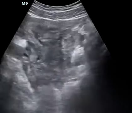 Figure 140.3_ Suprapubic View, Transverse.mp4 on Vimeo